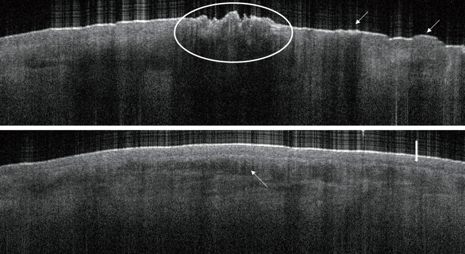 Actinic Keratosis (AK) – VivoSight