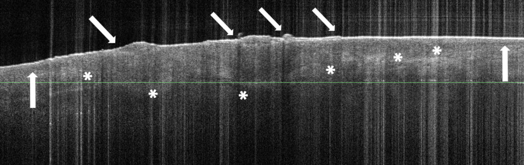 Actinic Keratosis (AK) – VivoSight