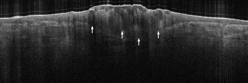 Actinic Keratosis (AK) – VivoSight