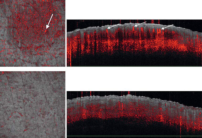 Skin Vasculature & Blood Flow – VivoSight