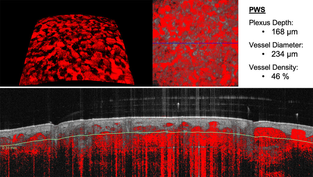Skin Vasculature & Blood Flow – VivoSight