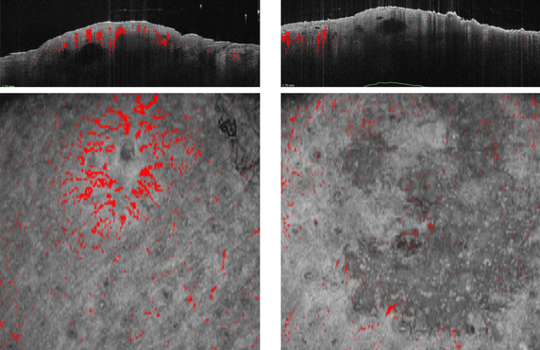BCC & SCC – VivoSight