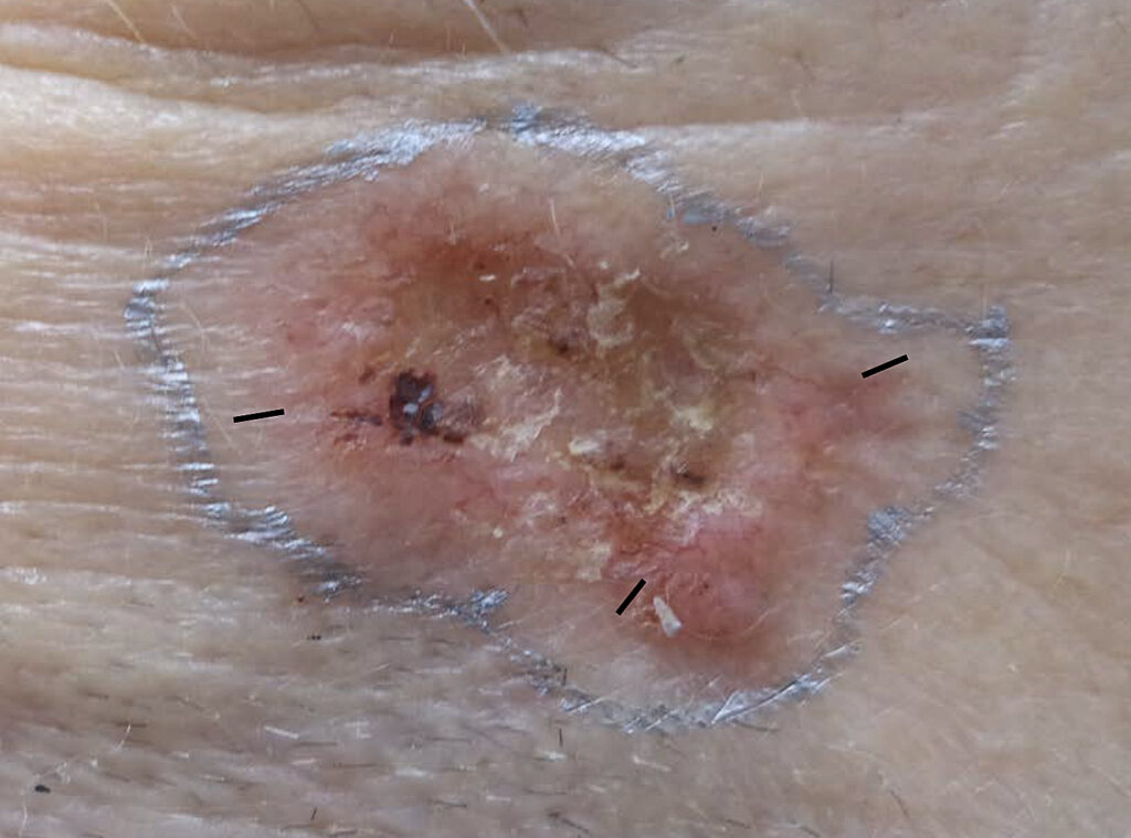 Mohs Micrographic Surgery – VivoSight