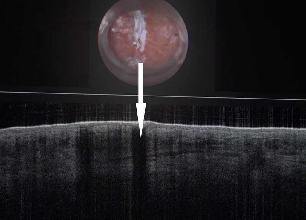 Mohs Micrographic Surgery – VivoSight