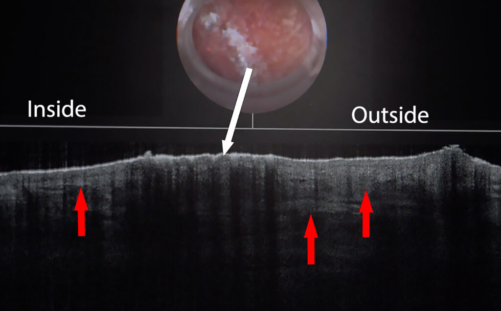Mohs Micrographic Surgery – VivoSight