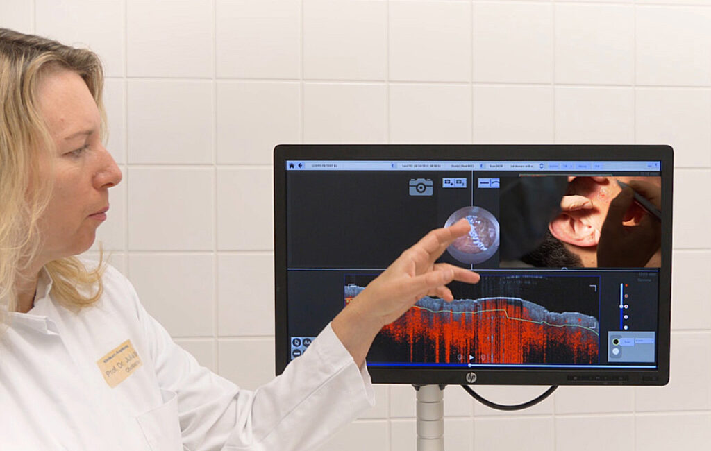Mohs Micrographic Surgery – VivoSight
