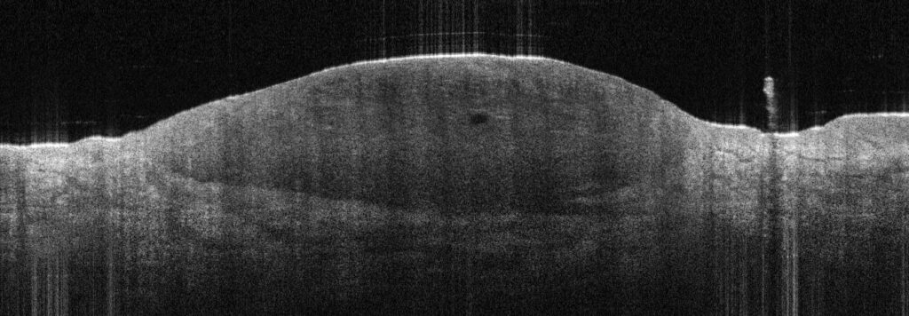 BCC & SCC – VivoSight