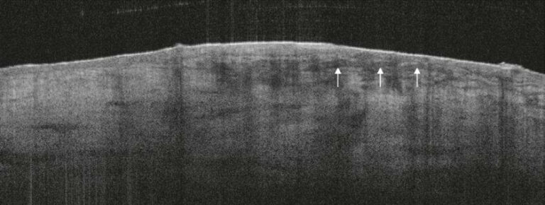 BCC & SCC – VivoSight