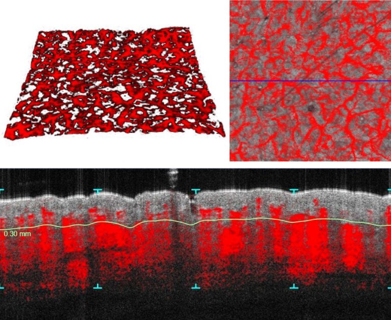 Basal Cell Carcinoma (BCC) Steph – VivoSight