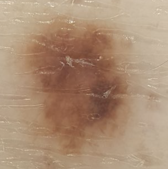 Study finds Dynamic OCT can distinguish nevi and melanomas based on ...